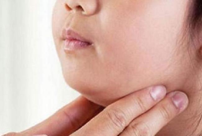 Cómo identificar, prevenir y tratar la Parotiditis o Paperas ...