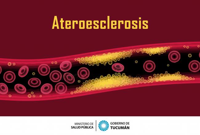 ¿Qué es la arterioesclerosis y cómo detectarla a tiempo? - Comunicación ...