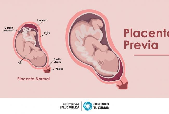 ¿cuáles Son Las Causas Y Los Síntomas De La Placenta Previa En El